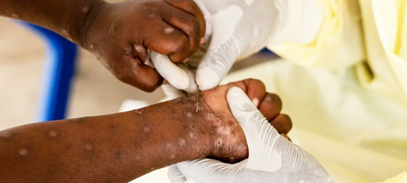 Casos pontuais de Mpox impedem o país de declarar fim do surto - O País ...