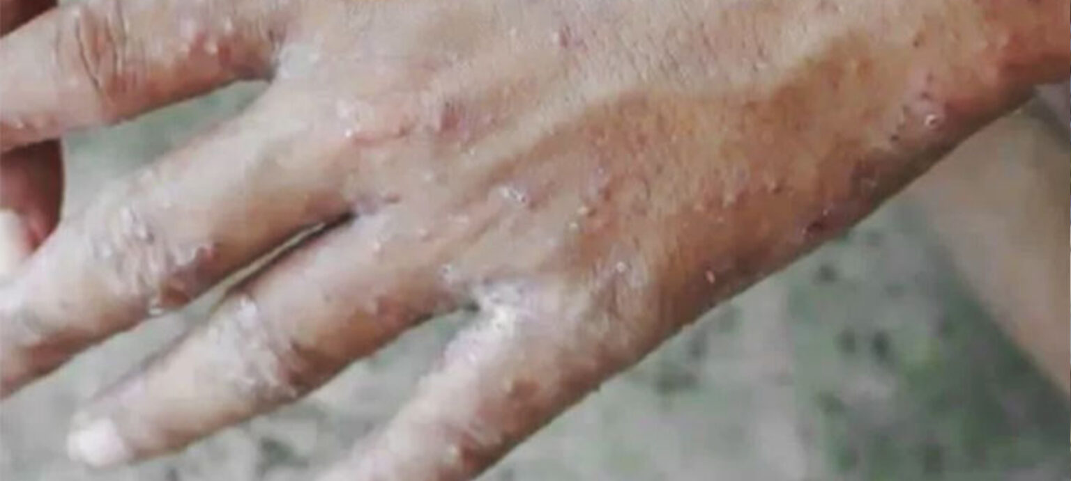 Reduzem casos de sarna na Província de Maputo - O País - A verdade como notícia